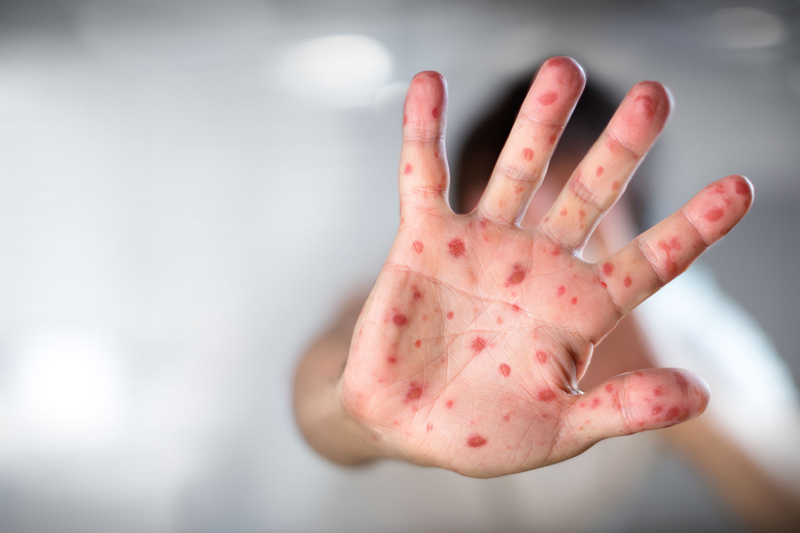 Ospice (morbili) - usporedba s kozicama, simptomi i liječenje