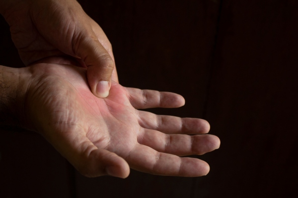 Peta bolest (erythema infectiosum): uzroci, simptomi i liječenje